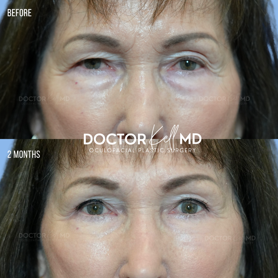 Lower Eyelid Blepharoplasty in San Diego, CA | San Diego Eye & Face